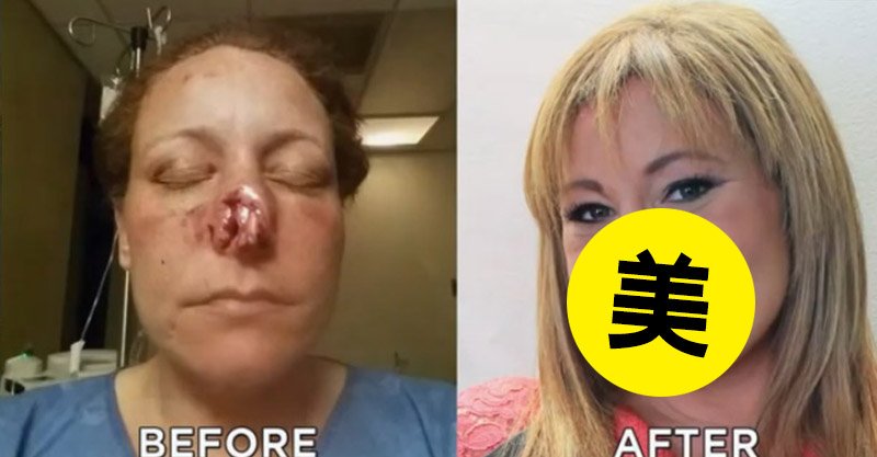 這名女性被前男友「殘忍咬掉鼻子」，奇蹟重建手術後的「超正自信模樣」真的讓人太感動了！ | TEEPR 亮新聞