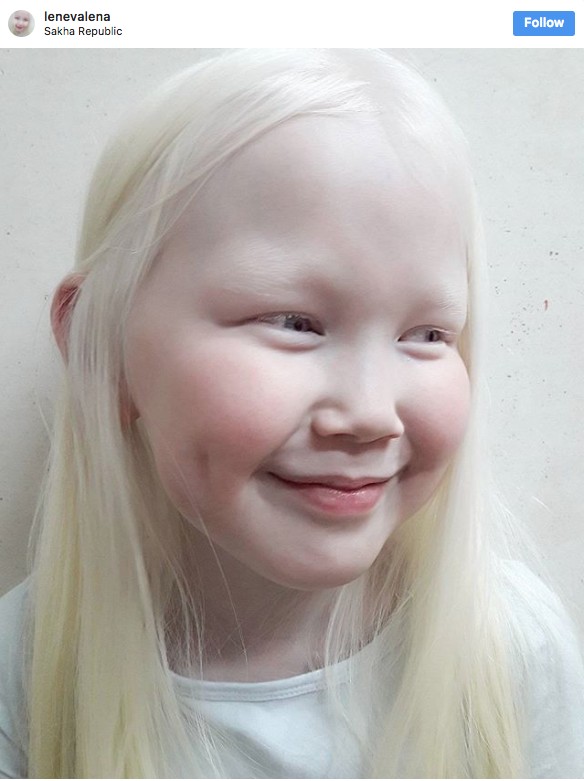 22張世界各地珍貴的「不同種族白化症之美」照片！