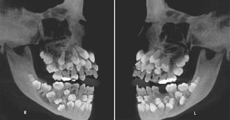 女童拔乳牙嚇壞牙醫！X光驚見「81顆牙塞滿嘴」 | TEEPR 亮新聞