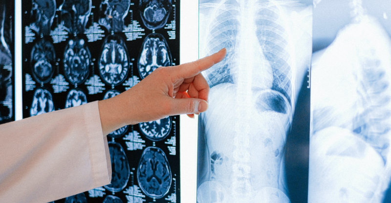 30歲女師健檢發現「肺結節」不管 1年後竟變「肺腺癌末期」 | TEEPR 亮新聞